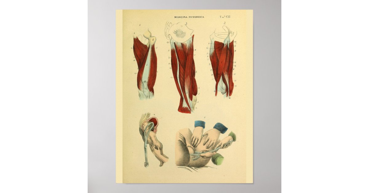 Poster Thigh Muscles Birth Forceps Anatomy Art Print | Zazzle.fr